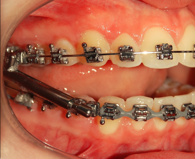 Protrator Mandibular: Quais as indicações, Passo a Passo de instala...