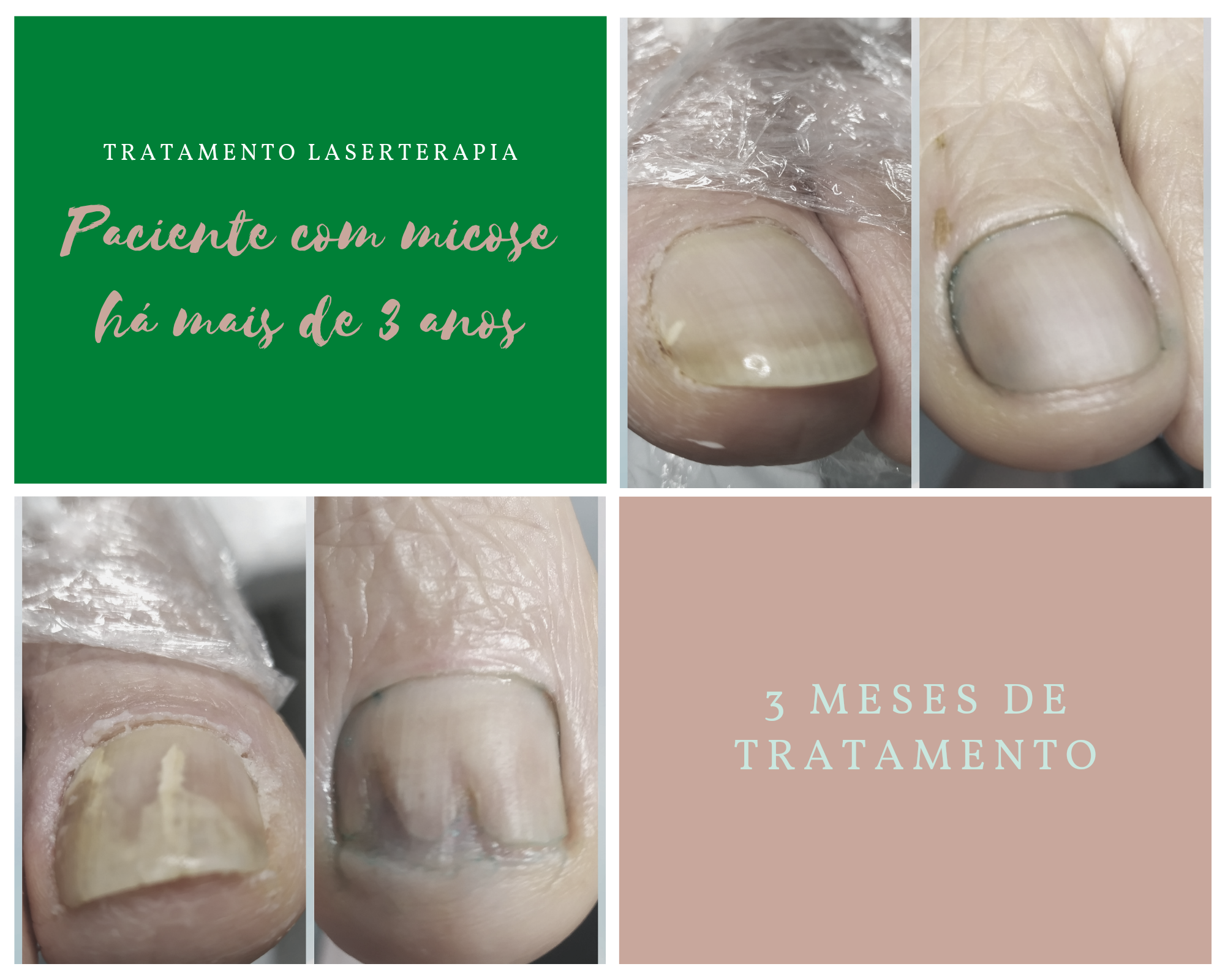 Onicomicose e Laserterapia - Joice Ribeiro Machado | Hotmart