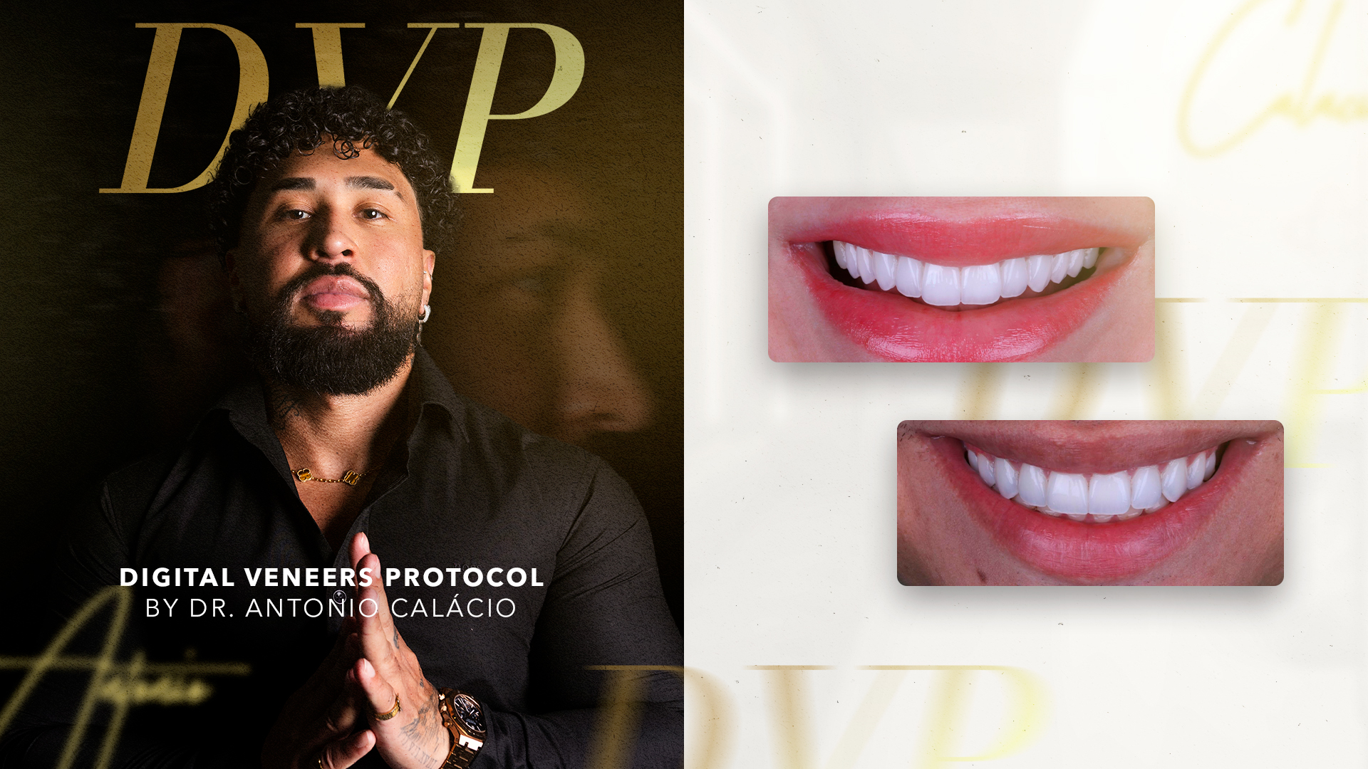 DVP: Digital Veneers Protocol - English - Antônio Calacio | Hotmart