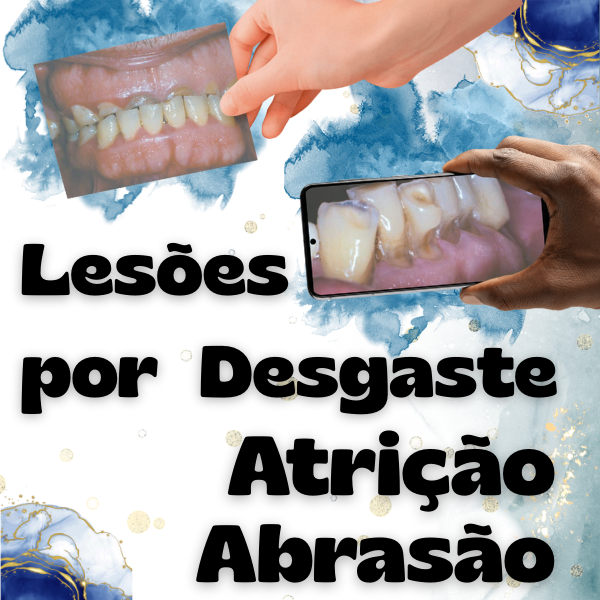 PDF - Atrição e Abrasão Lesões por DEGASTE DA ESTRUTURA DENTAL - Aula 50