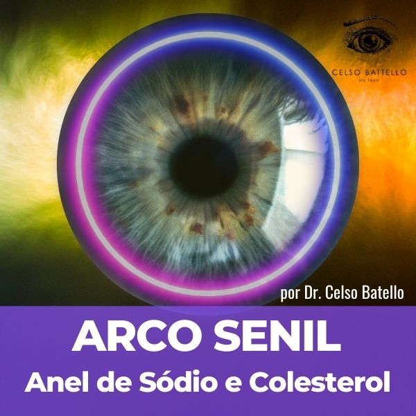 Iridologia - Arco Senil / Anel de sódio e colesterol
