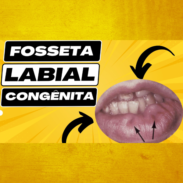 PDF - Fosseta labial congênita (paramediana) Características clínic...