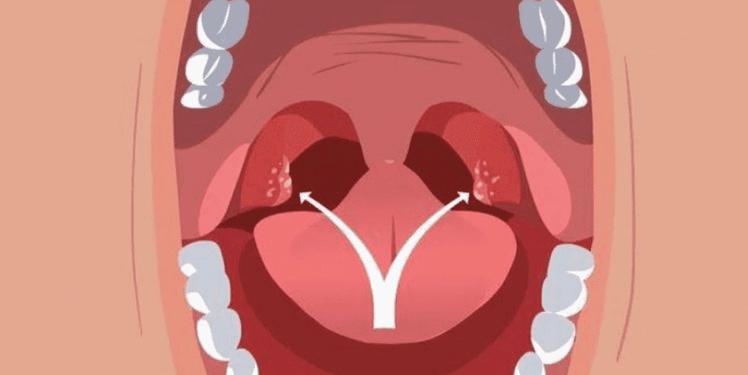 Receta Anticálculos