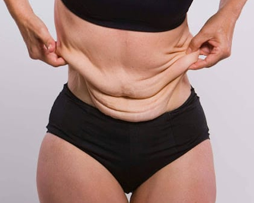 Método Zero Flacidez