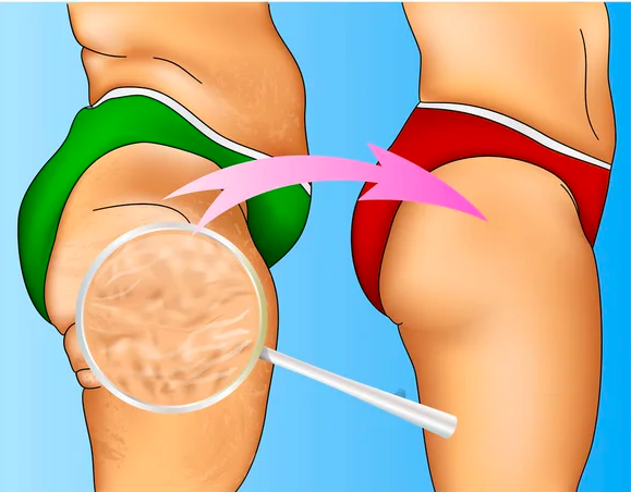 ZERO Cellulite and Sagging - Marketing Extreme LTDA | Hotmart