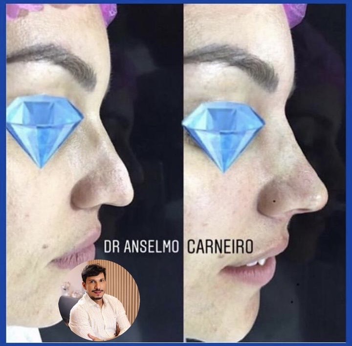 Rinomodelação FAST NOSE - Zione Clinic | Hotmart