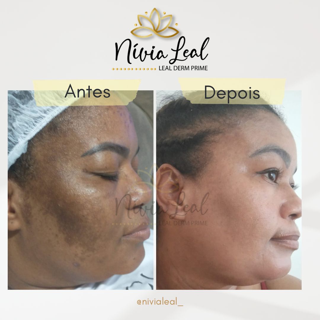 Tratamento de Melasma com resultados em 15 dias - Nívia Leal Ferrei...
