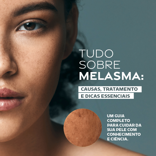 TUDO SOBRE MELASMA: CAUSAS, TRATAMENTO E DICAS ESSENCIAIS - Alessan...