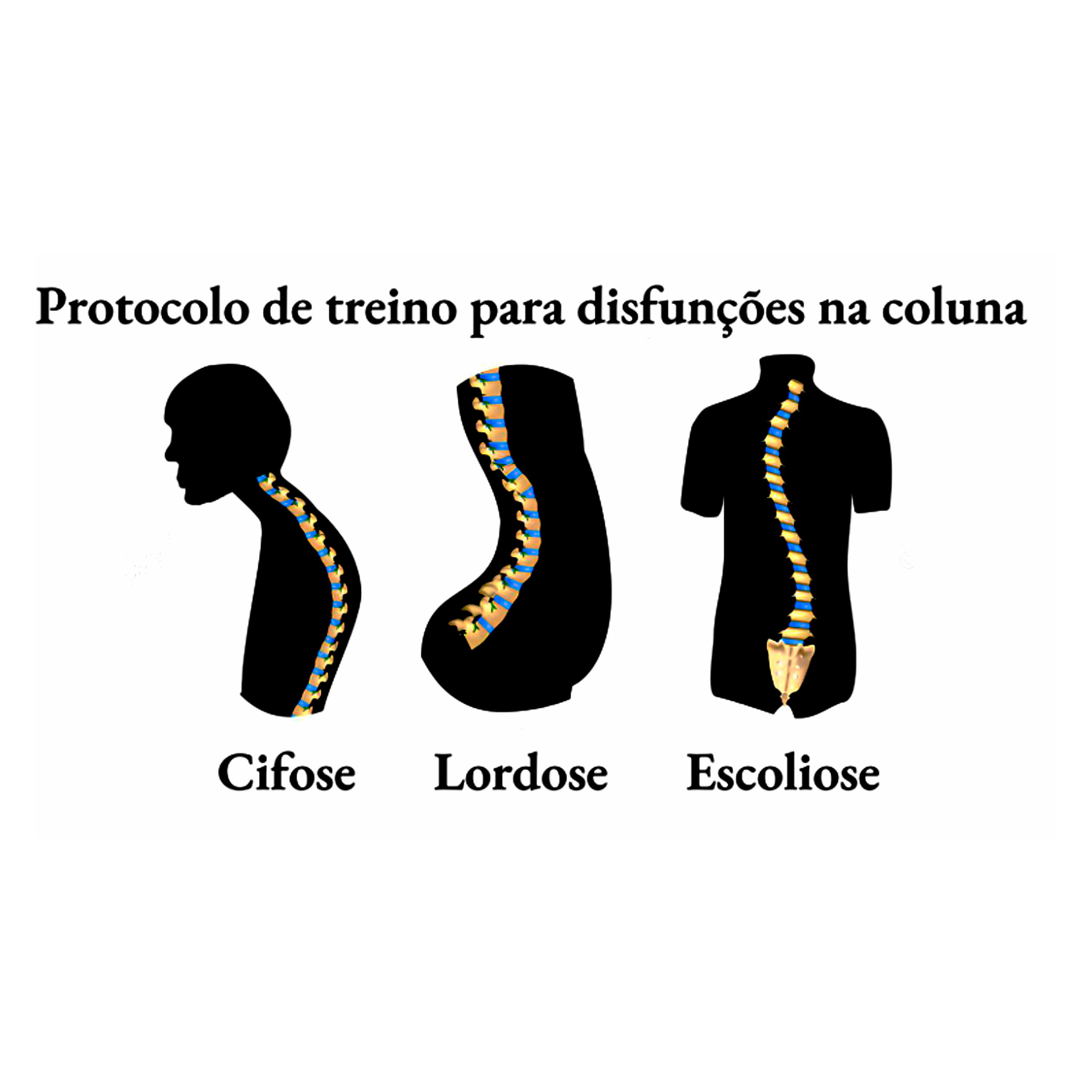 Protocolo de correção - escoliose, lordose e cifose - Paulo Persona...