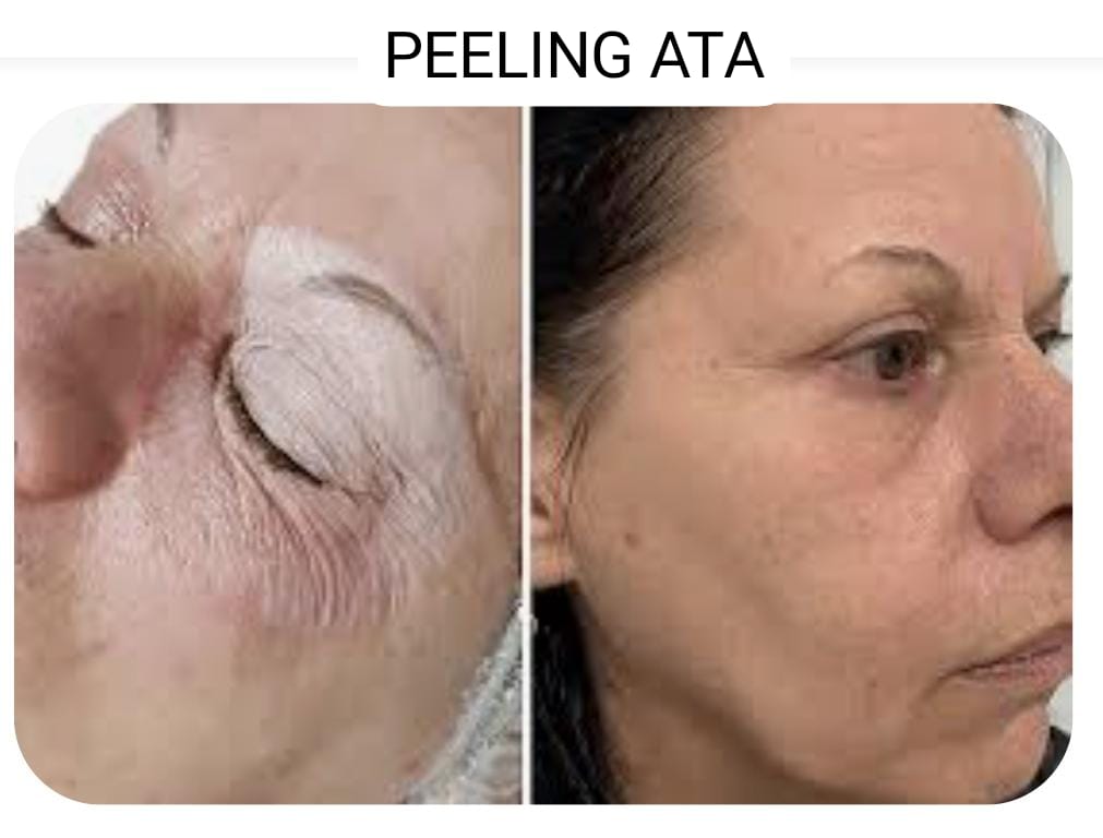 Peeling ATA- Ácido tricloroacético