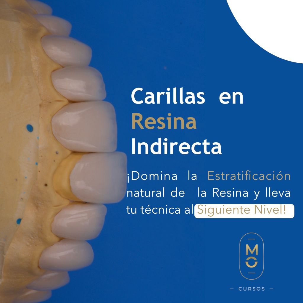 Carillas de resina técnica indirecta - Melissa Odontologa & Ós...
