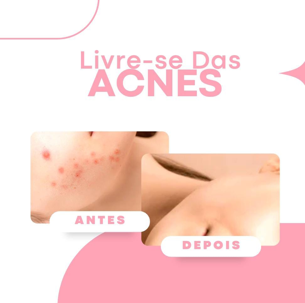 Livre-se das Acne - Ebook