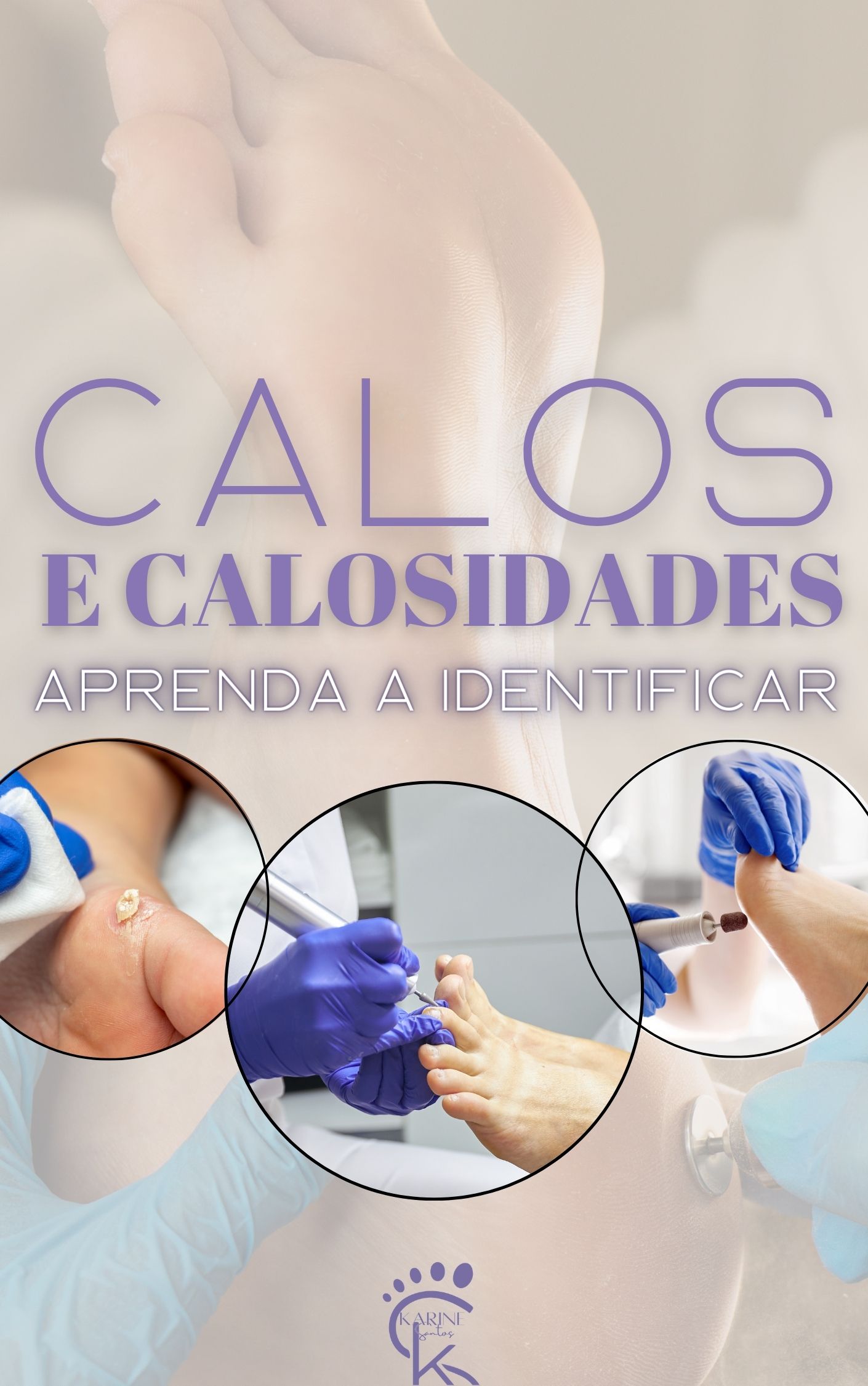 Tipos de Calos e Calosidades - Karine Santos | Hotmart