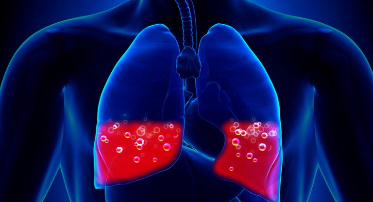 Manejo de edema agudo de pulmon en sala de emergencia - Dr. Juan De...