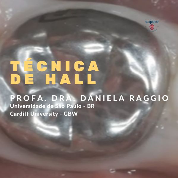 Técnica de Hall: uma solução eficaz para dentes posteriores - SAPER...