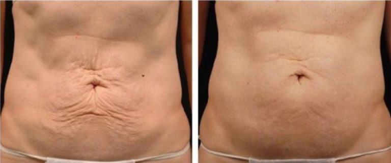 ZERO FLACIDEZ Y CELULITIS - David Alonso | Hotmart