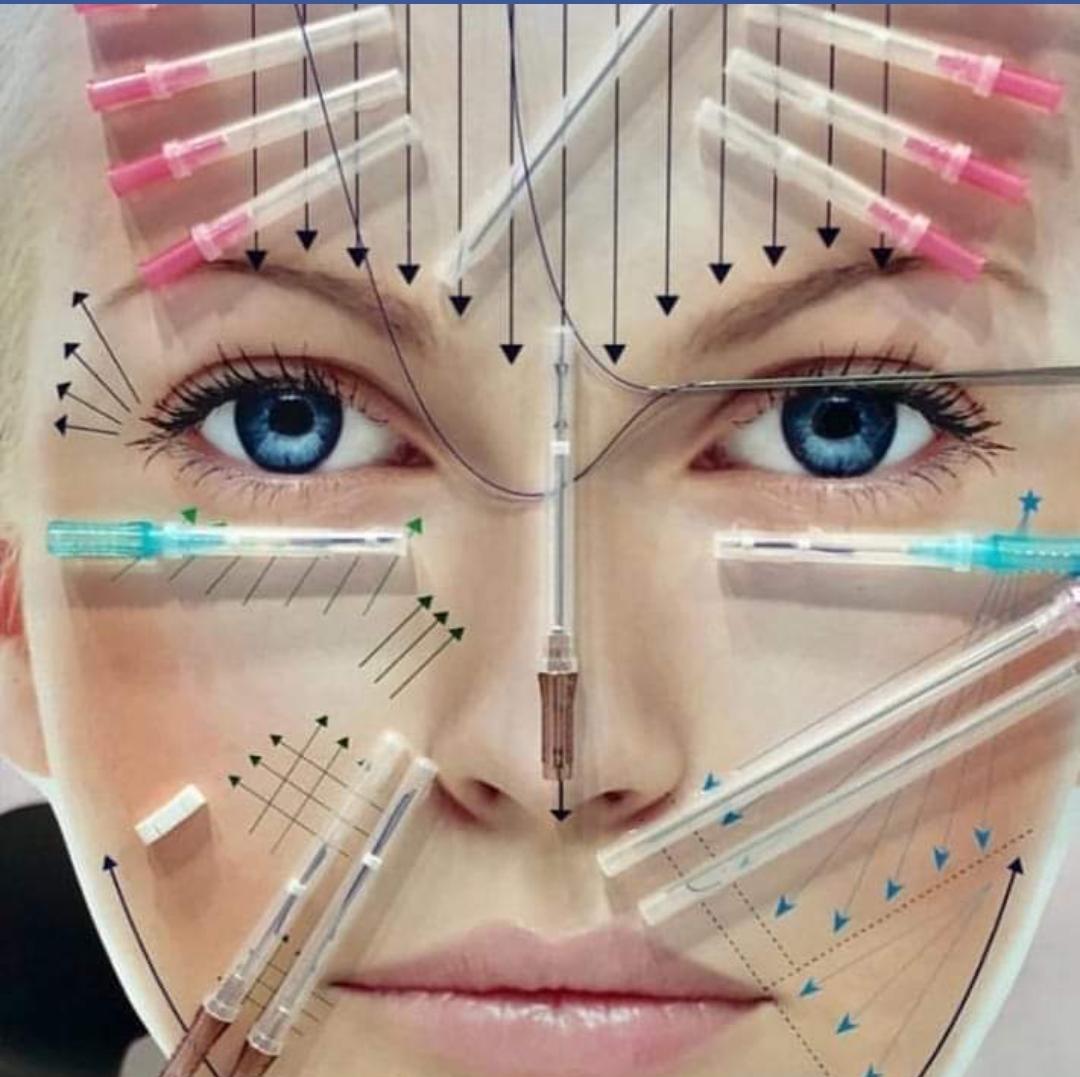 Fios de Polidioxanona ( Facial e Corporal)