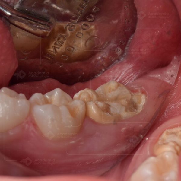 HMI - Hipomineralização Molar-Incisivo - Academia da Odontologia Cu...