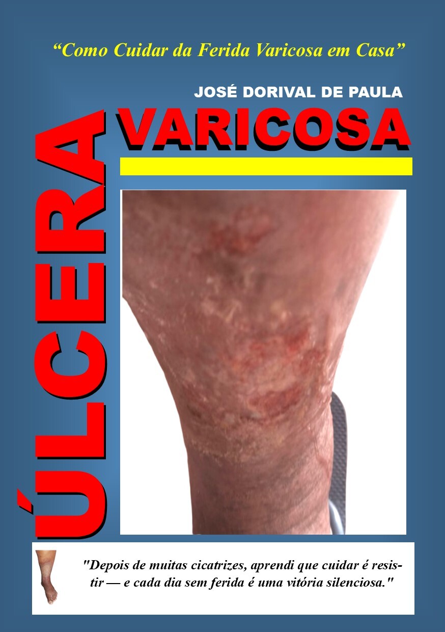 Como cuidar da Ferida Varicosa em Casa - José Dorival de Paula | H...