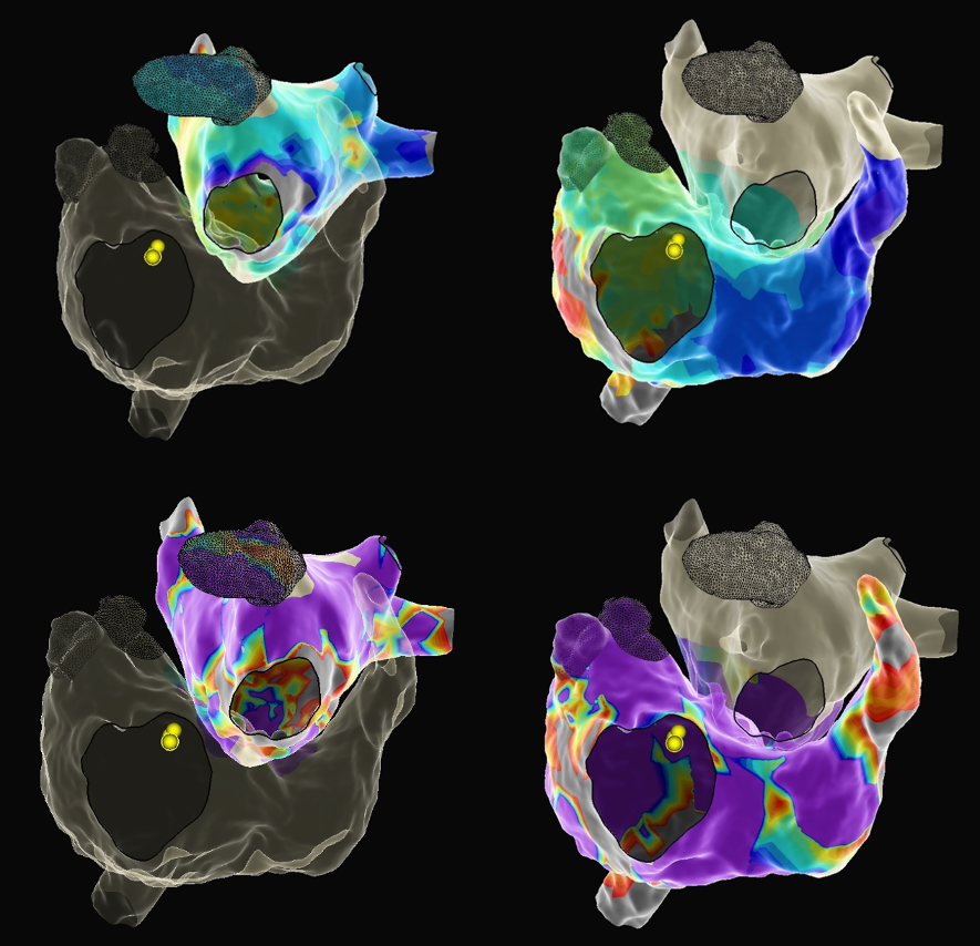 Absent right superior and persistent left superior vena cava - Elec...