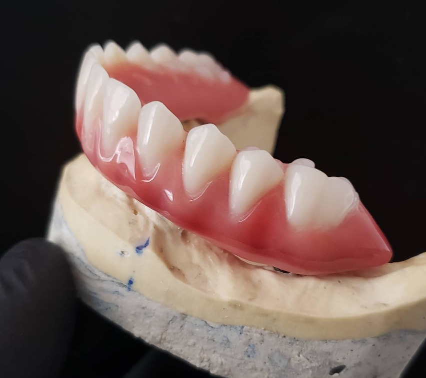 PRÓTESE DENTÁRIA: PROTOCOLO DE BRANEMARK RESINA - Leonardo Franzoni...