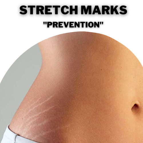 Stretch Marks Prevention