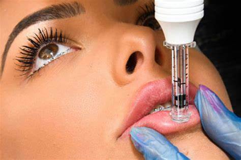 Hyaluron Pen Expert: Labios Perfectos Sin Agujas - ESS | Hotmart