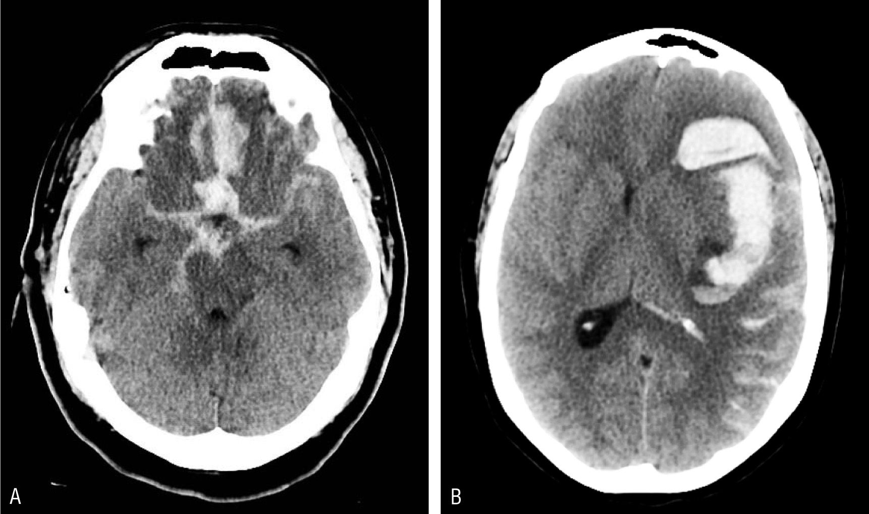 Manejo de Pacientes com Hemorragia Subaracnóide