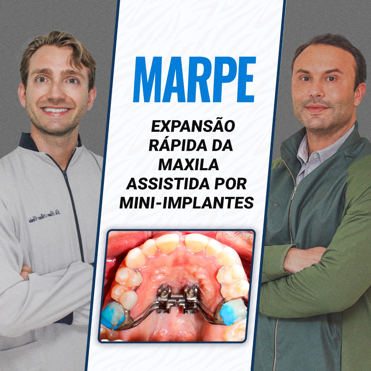 Marpe - Expansão rápida da maxila assistida por mini-implantes - H...