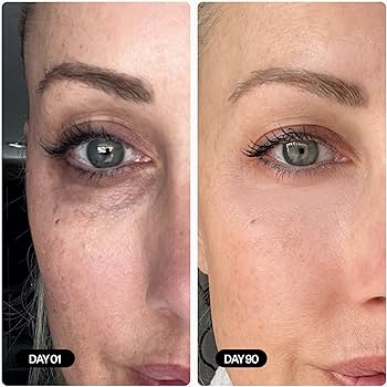 Curso clareamento de olheiras