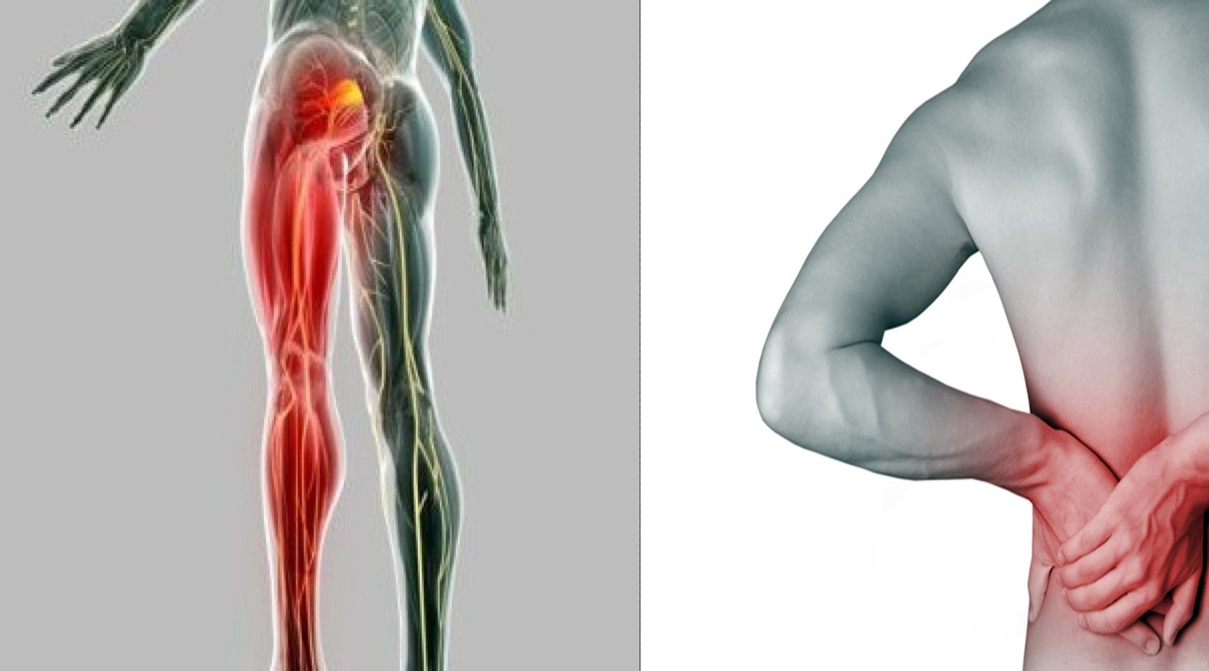 DOLOR LUMBAR LOCAL, REFERIDO, DOLOR RADICULAR Y RADICULOPATÍA - Vic...