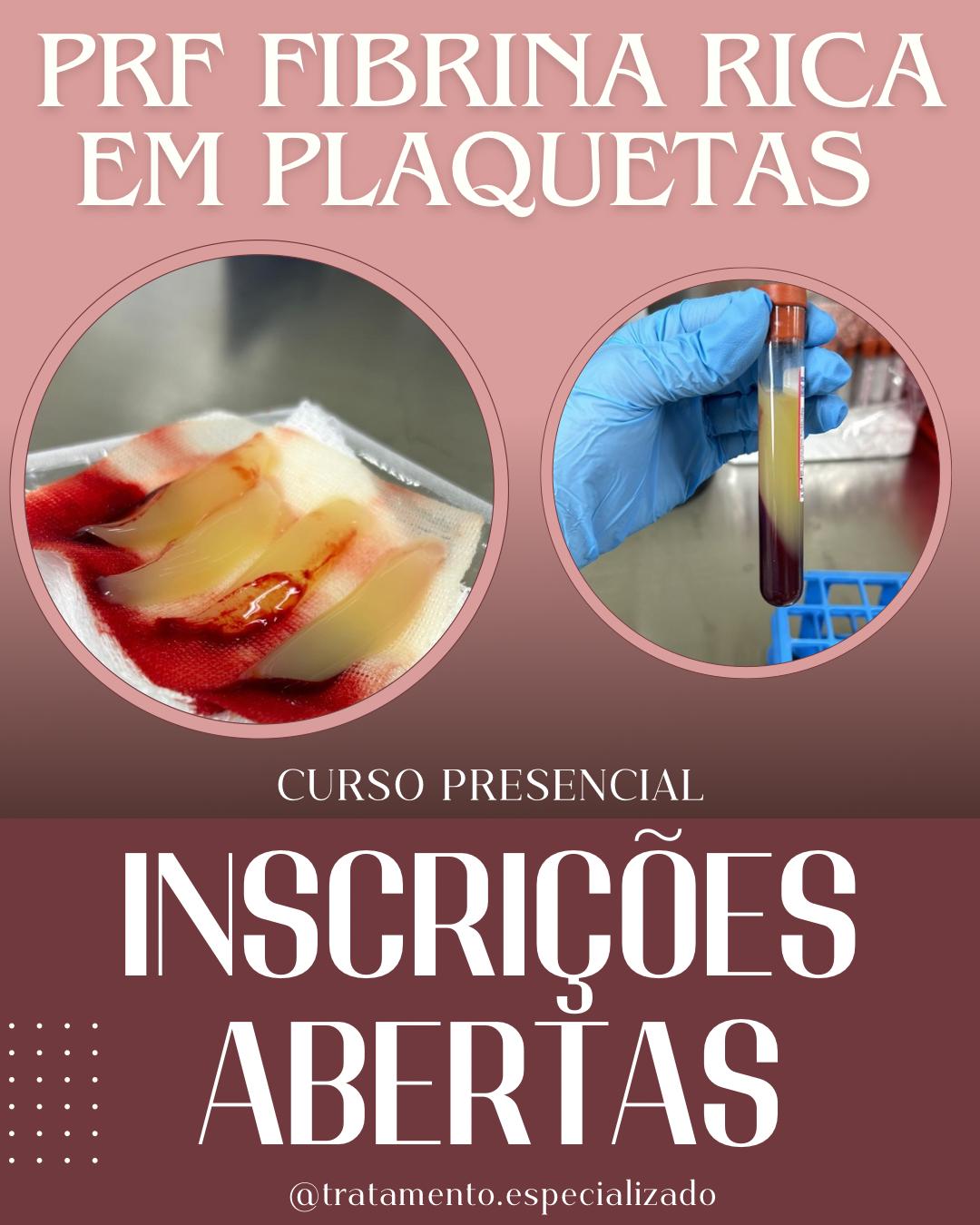 Curso PRF (fibrina rica em plaquetas) - Tratamento especializado De...