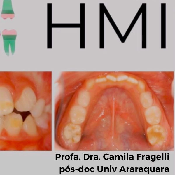 O que nunca te contaram sobre HMI (Hipomineralização molar incisivo)