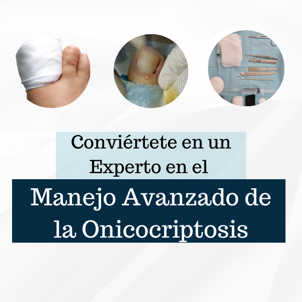 Podología: Manejo avanzado de la Onicocriptosis - Centro de Podolog...