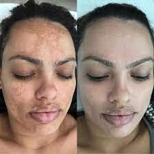 Clase: Peelings esteticos - Manuela Bernardi | Hotmart