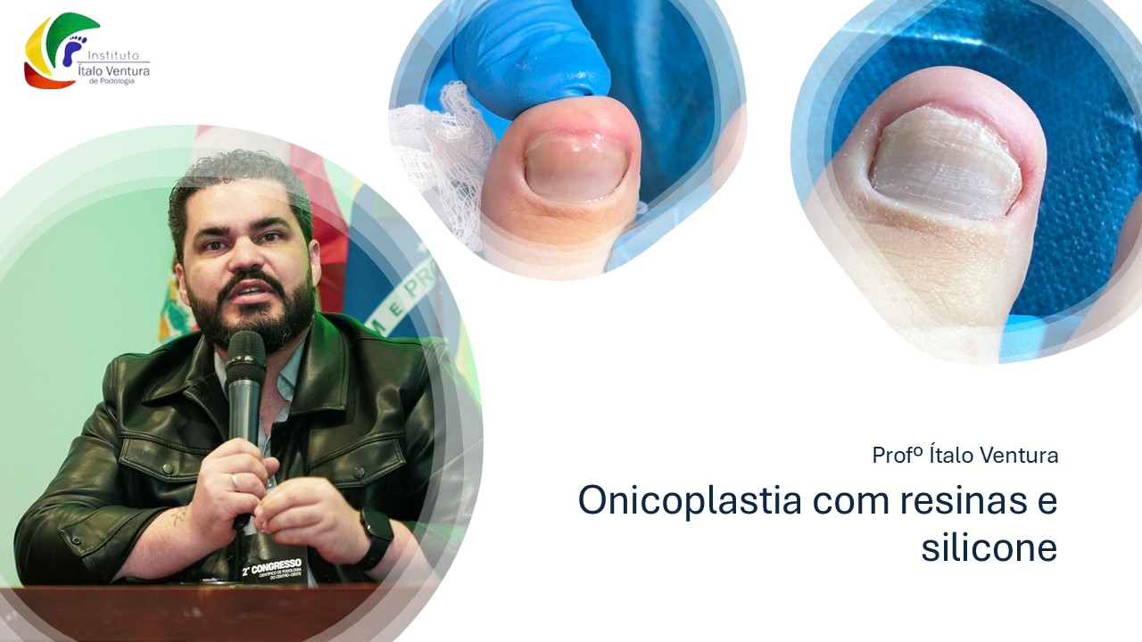 Curso de Onicoplastia - ITALO BATISTA VENTURA DA SILVA | Hotmart