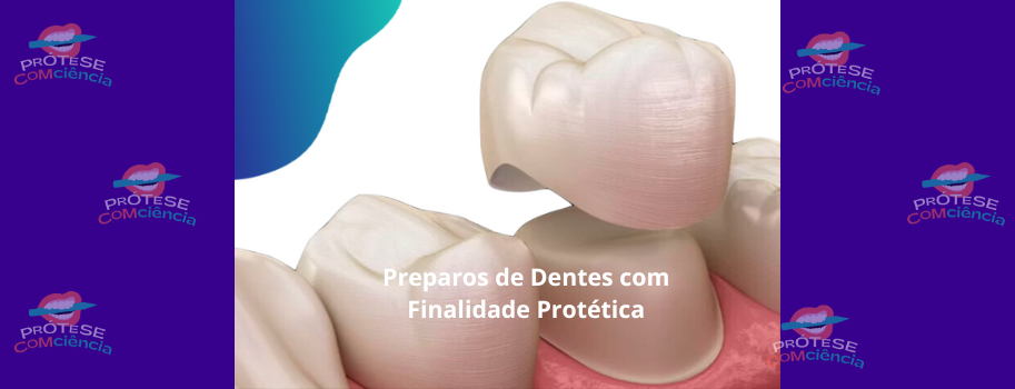 Caderno de Prótese: Preparos de Dentes com Finalidade Protética - P...
