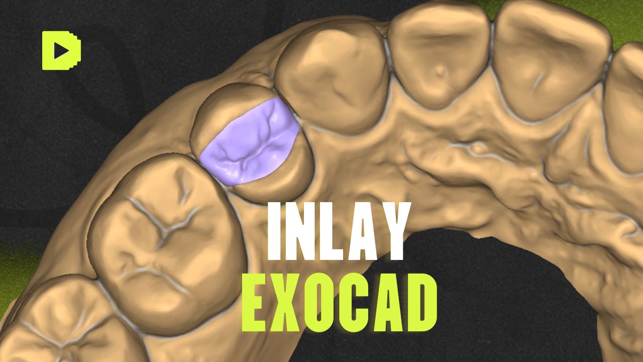 Restaurações Inlay no Exocad. - Pedro Duarte | Hotmart
