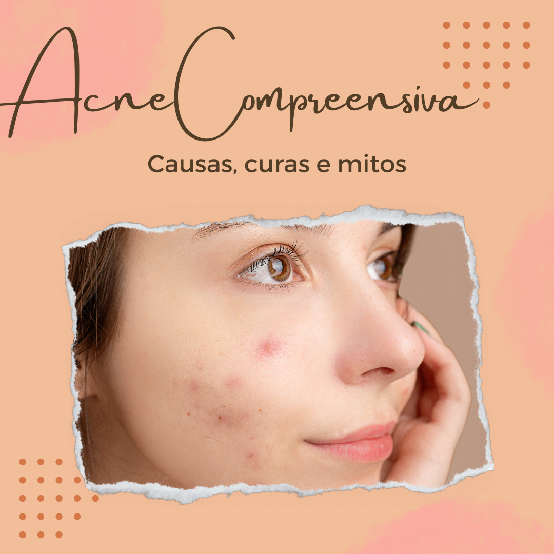 Acne Compreensiva Causas Curas e Mitos - Cássia Helena Arena Rodrig...