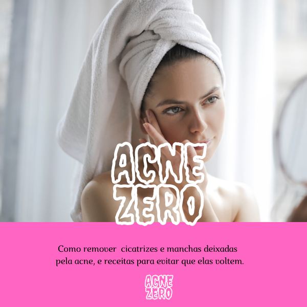 Acne Zero: Como remover manchas e Cicatrizes deixadas pelas Acnes.