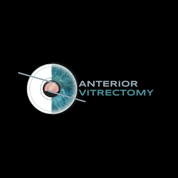 Anterior Vitrectomy - Orbit | Hotmart