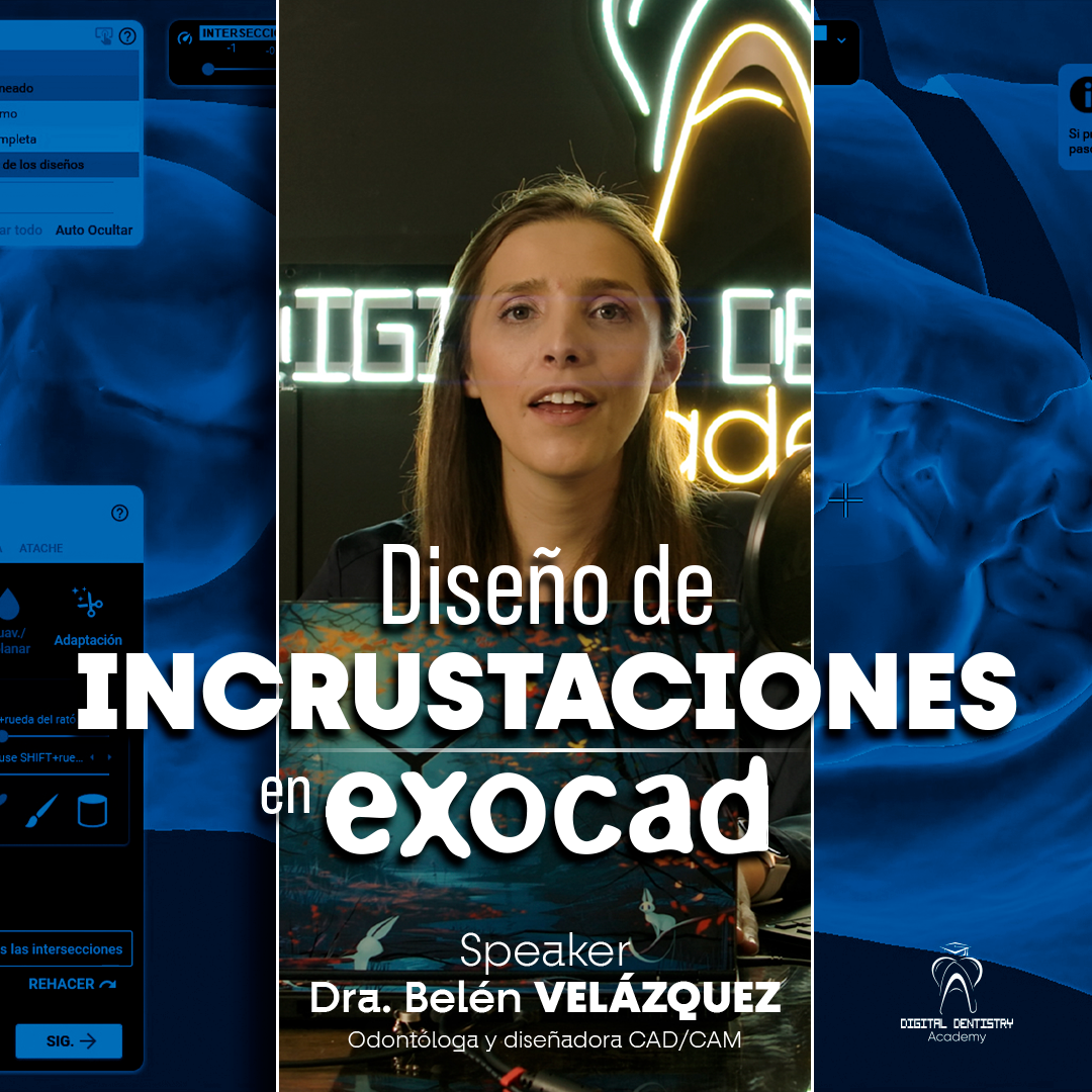 Diseño de Incrustaciones en EXOCAD - Digital Dentistry Academy | Ho...
