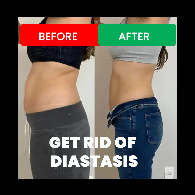 Natural Supplementation To Treat Diastasis