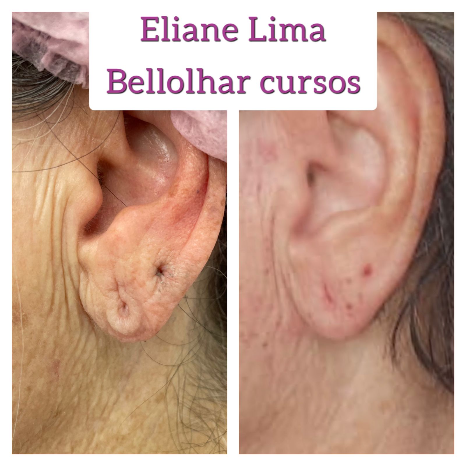 Lobuloplastia não cirurgica (sem cortes) com jato de plasma - BellO...