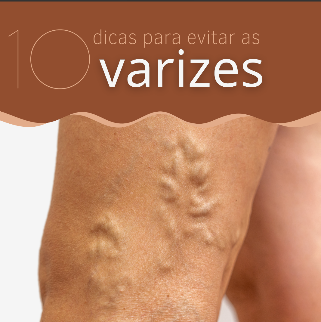Varizes: 10 Dicas Práticas para Combater e Prevenir - Marcelo Santa...