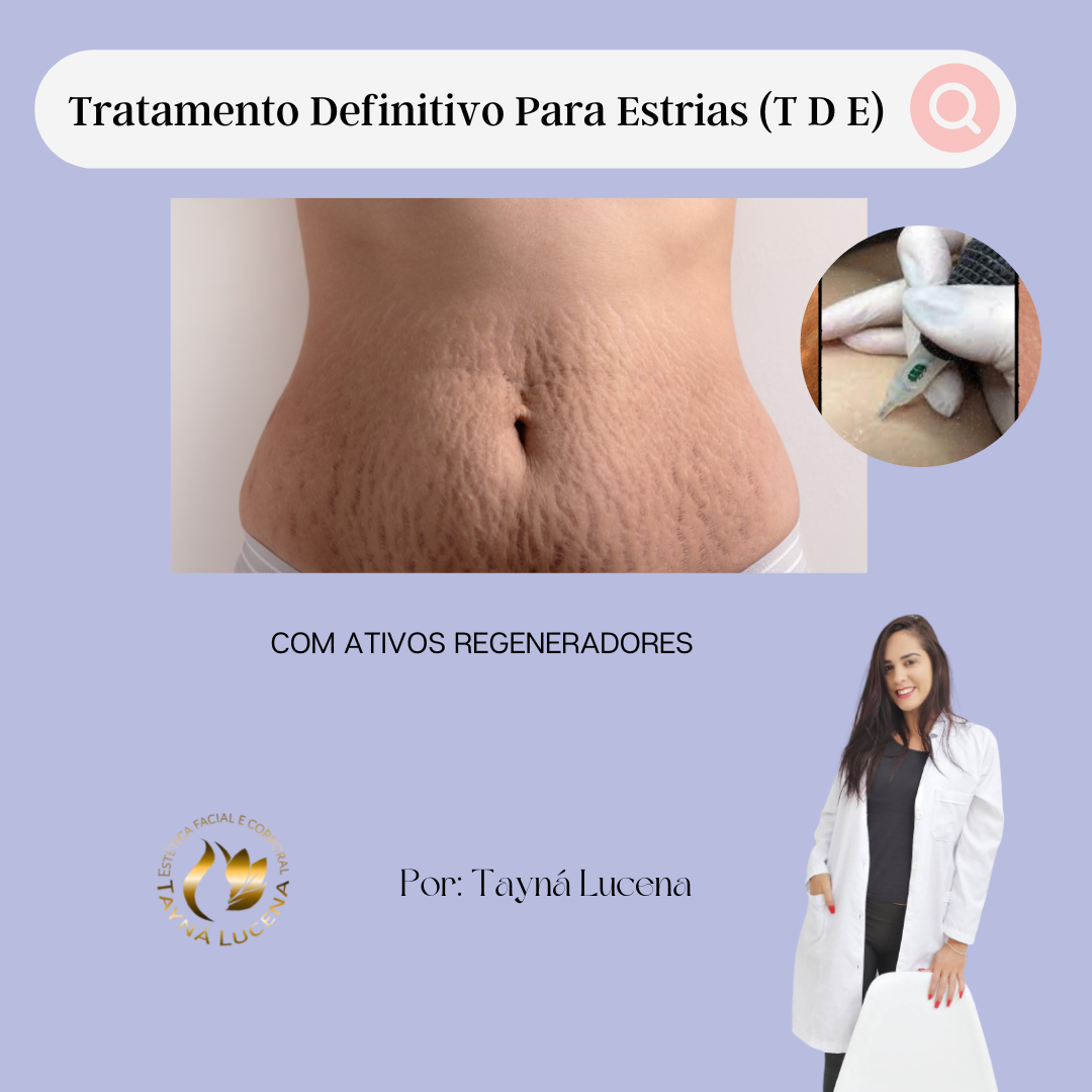 Tratamento Definitivo Para Estrias - Tayna de Lucena Silva | Hotmart
