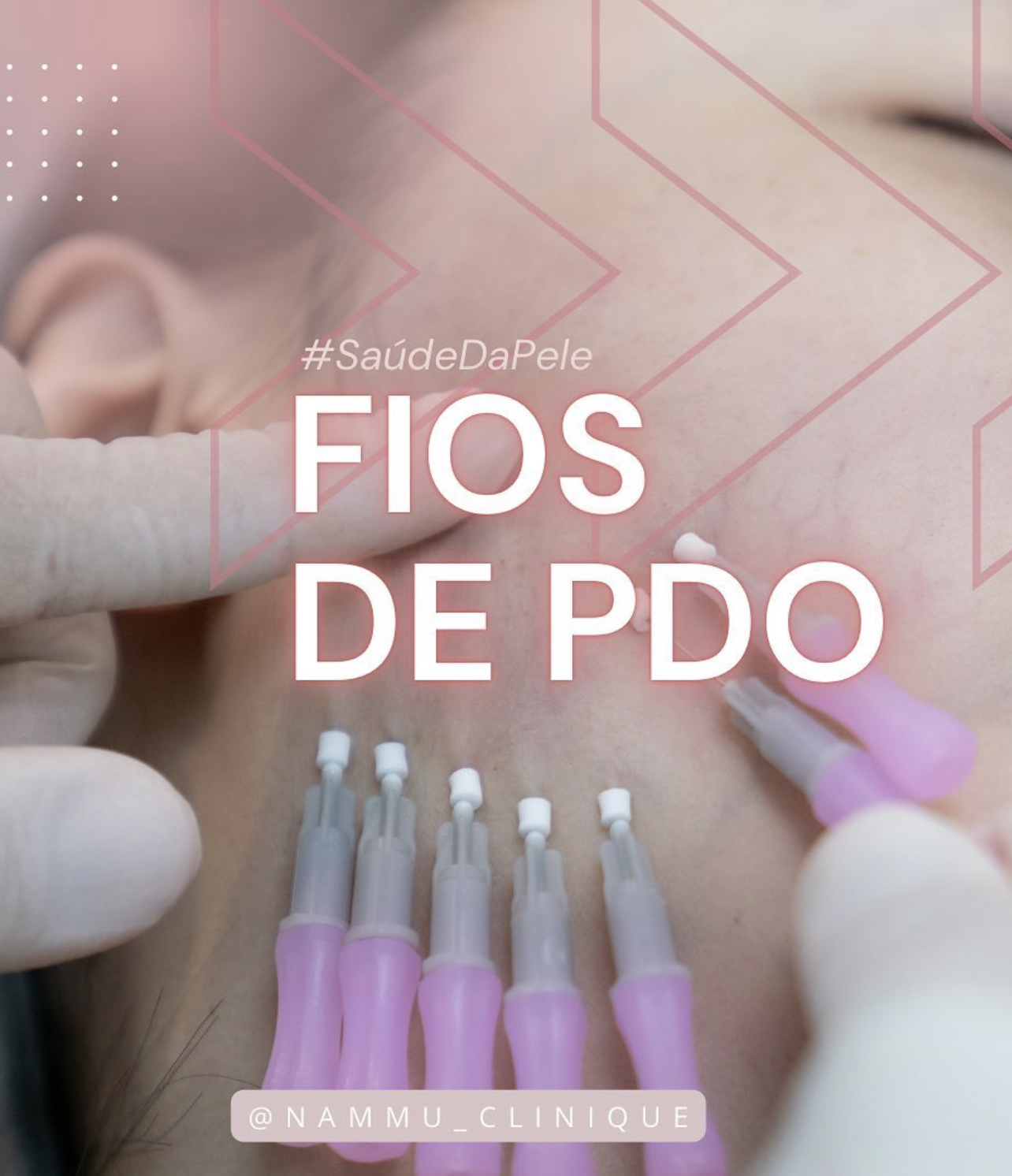 Fios de pdo - Emmanuella Medeiros S. L. Lima | Hotmart