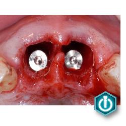 Videoaula: "Implantes Imediatos Pós-Extração"