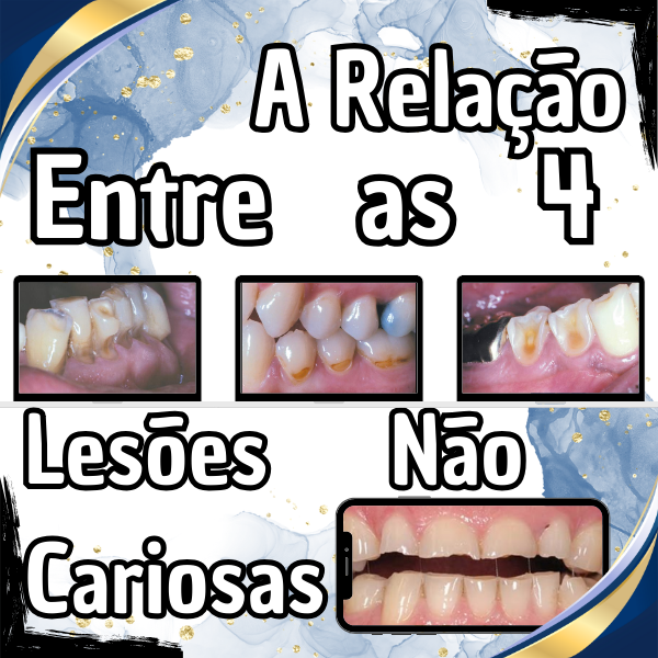 PDF - Qual a relação entre AS 4 LESÕES NÃO CARIOSAS - Atrição, Abrasão ...