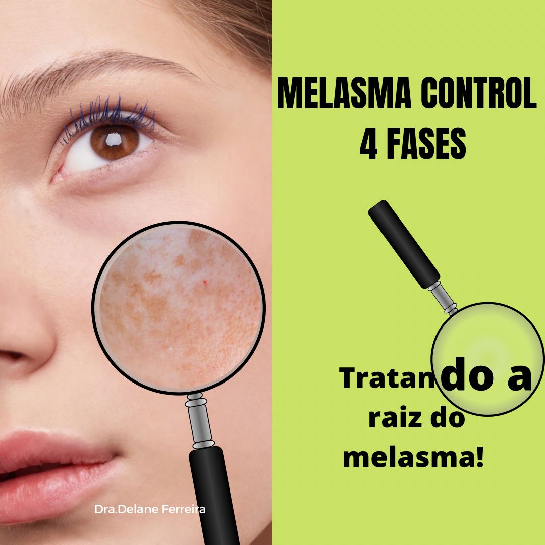Melasma control 4 fases - Dra. Delane Ferreira | Hotmart